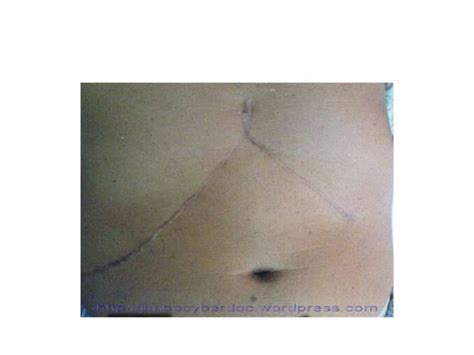 Types Of Incisions Presentation Lecture Pptx