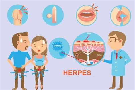 Sintomas Da Herpes Genital Clearance Cheapest Gbu Presnenskij Ru
