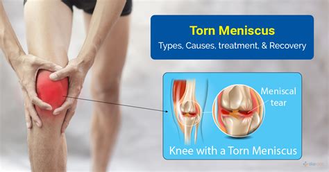 Torn Meniscus Types Causes Treatment And Recovery