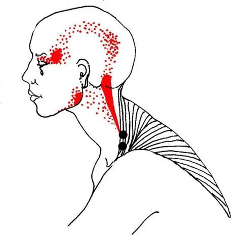 Trigger Point In The Muscles Trigger Point Massage Health