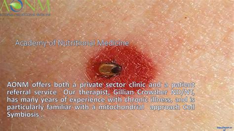 Lyme Disease Testing Ppt