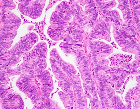 Pathology Outlines Adenocarcinoma