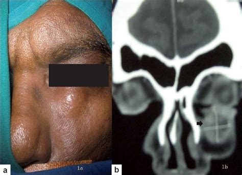 A Clinical Image With Left Infraorbital Swelling B Ct Scan