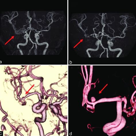 Follow Up Preoperative Imaging Findings A Magnetic Resonance