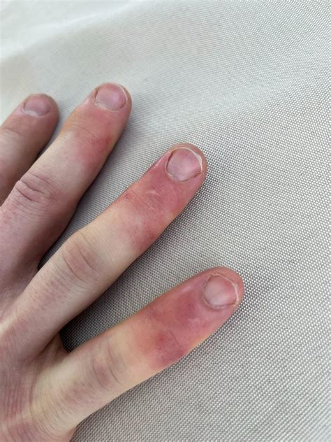 Is This Chilblains On My Fingers R Dermatologyquestions