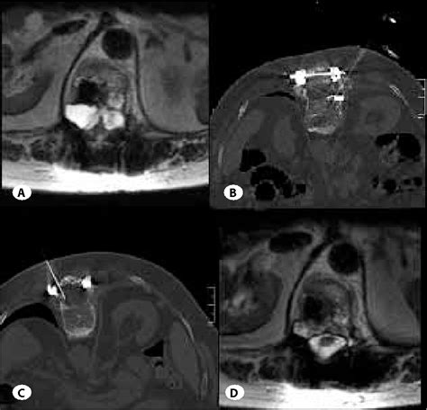 Figure 1 From Percutaneous Ct Guided Treatment Of Recurrent Spinal Cyst