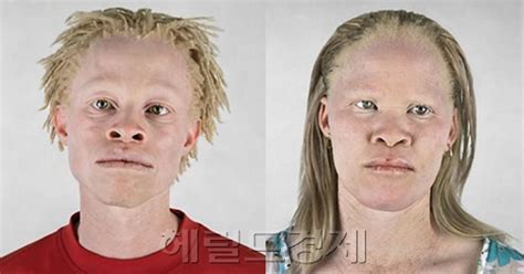 김현주 하얀 흑인 아프리카 알비노 실상에 충격