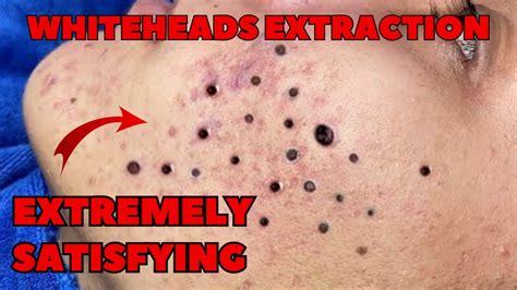 Satisfying Whiteheads Extraction Pimple Popping Relaxation Youtube