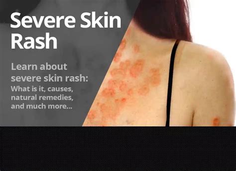 Skin Rash Types Symptoms Causes And Diagnosis Quran Mualim