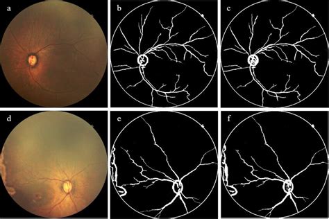 A Normal Fundus Image Of An Infant With Ga Of 34 Weeks B Ground Download Scientific Diagram