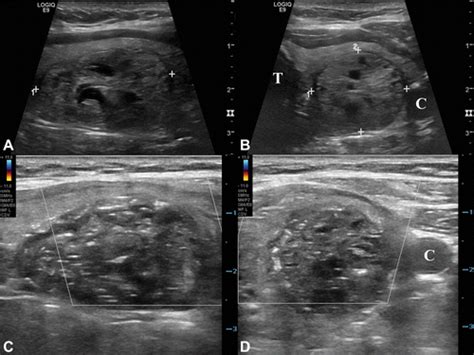 Radiofrequency Ablation For Benign Thyroid Nodules Radiology In