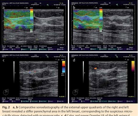 Figure 2 From Sonoelastographically Guided Preoperative Locali Zation