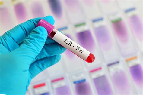 What Is An Esr Test Facty Health