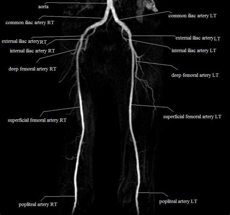 Upper Legs Vascular Anatomy Mra Legs Arteries Anatomy Thigh Arteries