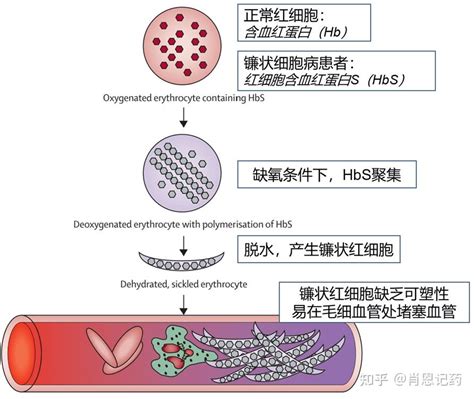 如何记住所有fda批准生物药？ P 选择素拮抗剂 Crizanlizumab 克立利珠单抗 镰状细胞病（scd） 知乎