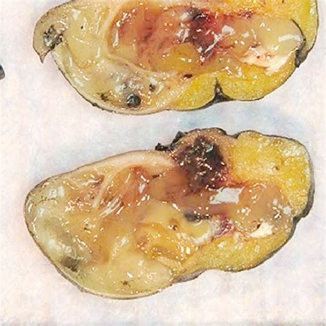 Low Grade Appendiceal Mucinous Neoplasms Lamn With Invasive Low Grade