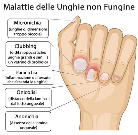 Malattie Delle Unghie