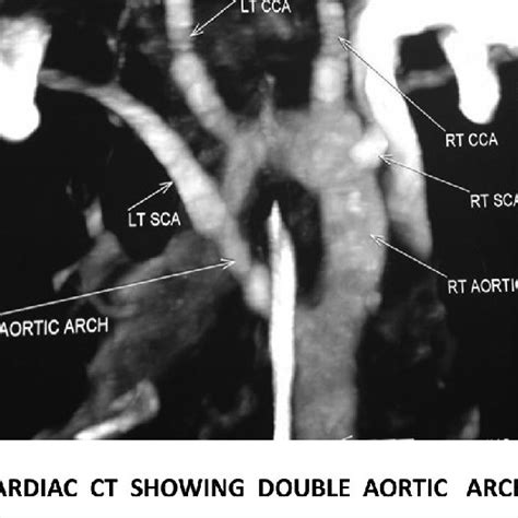 Contrast Enhanced Computed Tomography Scan Showing Double Aortic Arch