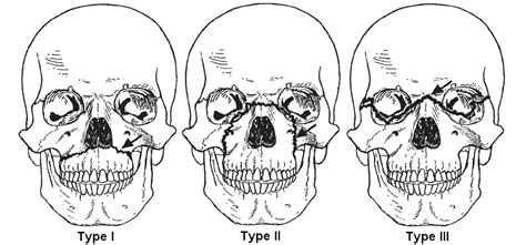 Facial Fractures Classification And Highlights For A 42 Off