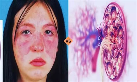 Difference Between SLE And Lupus Nephritis