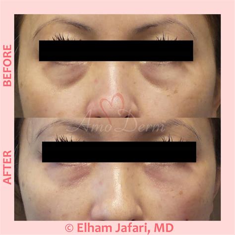 Treat Dark Circles And Bags Under Eyes Using Fillers And Lasers