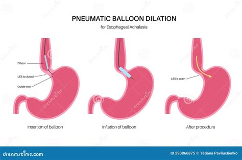 Endoscopic Pneumatic Dilation Stock Illustration Illustration Of