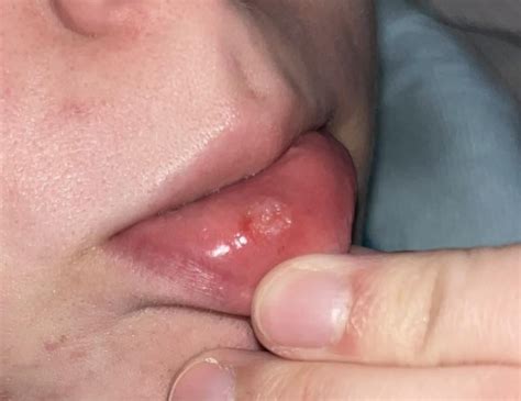 Day 11 Of The Worst Canker Sore Ive Ever Had Still Getting Bigger Doing Salt Water Rinses