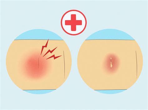 How To Remove Nexplanon Where To Get It Removed And More