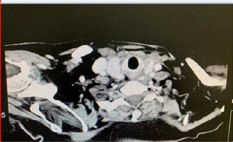 Ct Neck On Follow Up Showed No Recurrence Download Scientific Diagram