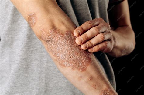 Premium Photo Acute Psoriasis On The Elbows Is An Autoimmune Incurable Dermatological Skin