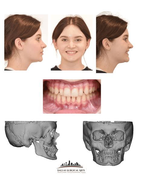 Jaw Repositioning Orthognathic Surgery Dallas Surgical Arts