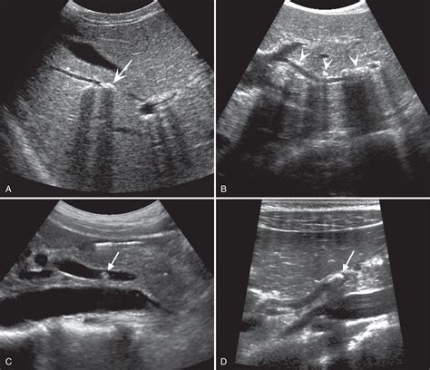 The Biliary Tree And Gallbladder Clinical Tree