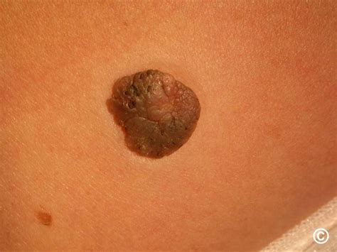 Seborrhoeic Keratoses