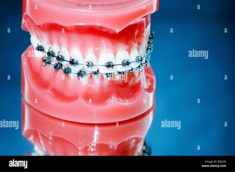Teeth Braces Fotos Und Bildmaterial In Hoher Auflösung Alamy