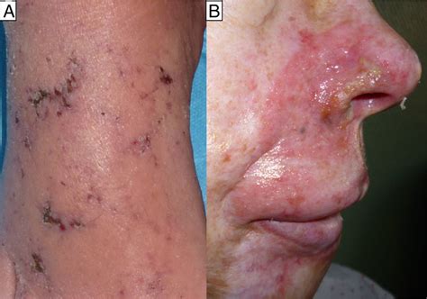 Acral Erosions And Ulcers An Early Sign Of Severe Acute Methotrexate