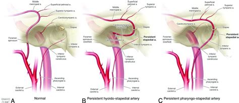 The Many Faces Of Persistent Stapedial Artery Ct Findings And