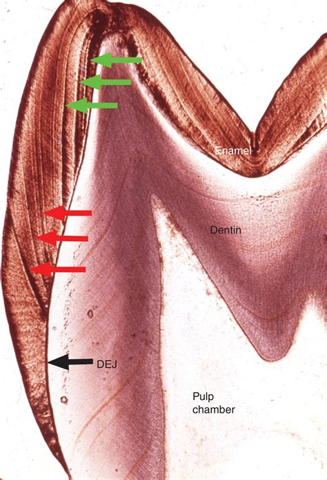 4 Enamel Pocket Dentistry
