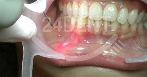 แผลร้อนในใช้เวลากี่วันถึงจะหาย 24dent
