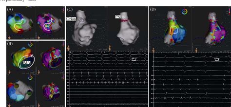 Figure 2 From Automated Ultrahigh Density Mapping In Atrial