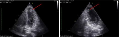 Diffuse Lad And Lv Thrombus As Possible Manifestation Of Protein S