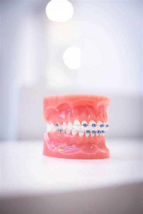 How To Keep Your Braces Clean The Ultimate Guide To Oral Hygiene