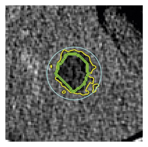 tumor segmentation using the proposed method drls with two different