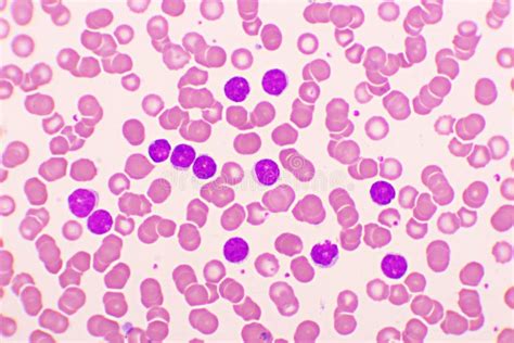 Chronic Lymphocytic Leukemia Or Cll Stock Image Image Of Erythrocyte