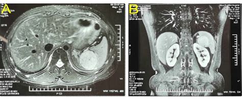Bloodless Laparoscopic Partial Splenectomy Assisted By Bipolar