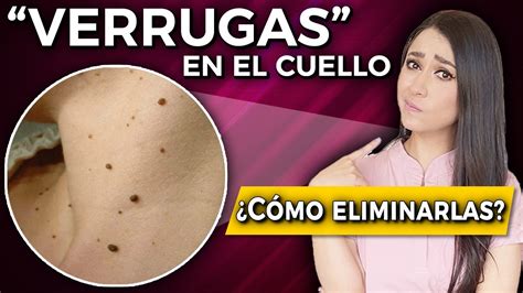 Verrugas” En El Cuello L Cómo Eliminarlas Qué Son Y Por Qué Salen👩🏻‍⚕