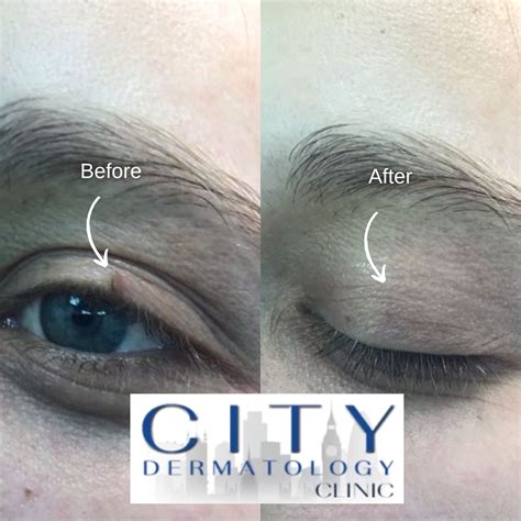 Eyelid Skin Tag Removal London From £245 Same Day Treatment