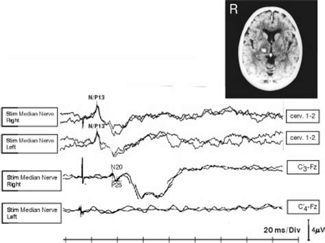 Absent Median Ssep Over The Right Hemisphere 65 Year Old Man With Download Scientific Diagram
