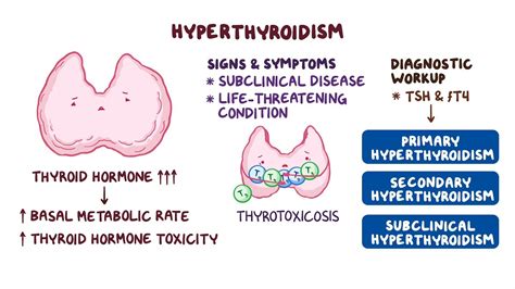 Approach To Hyperthyroidism And Thyrotoxicosis Clinical Sciences Osmosis Video Library