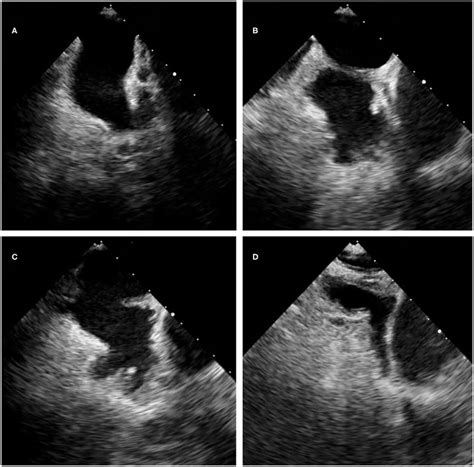 The Laa Morphology By 2d Transesophageal Echocardiography A The