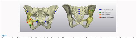 Figure 3 From High Accuracy Of Positioning Custom Triflange Acetabular Components In Tumour And